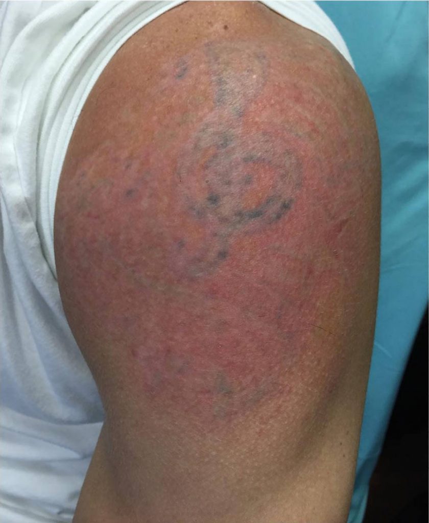 Tattoo Regret? Here’s Everything You Need To Know - Jiva Med Spa