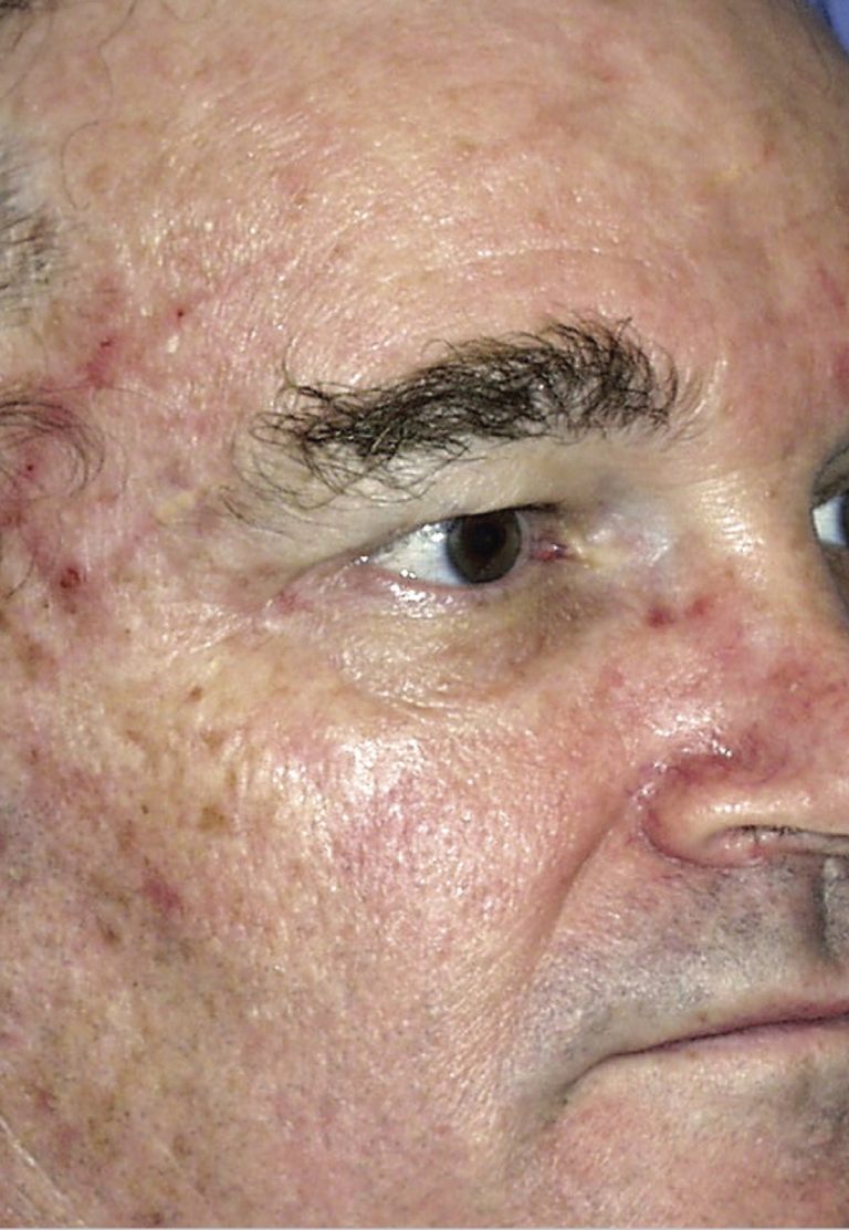 How To Reverse Years Of Sun Damage On Your Face - Jiva Med Spa